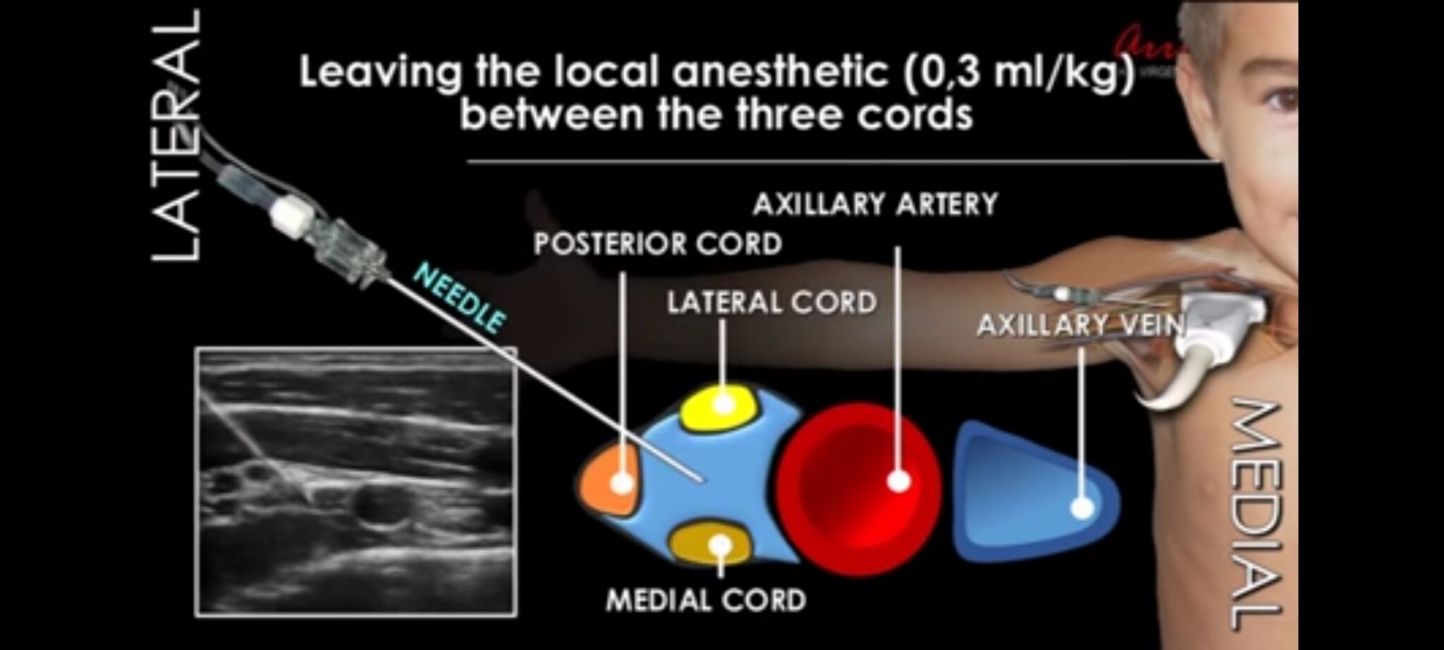 Costoclavicular Brachial Plexus Block