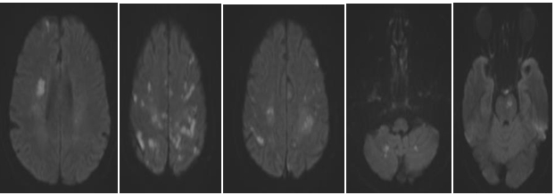 Fat Embolism Syndrome