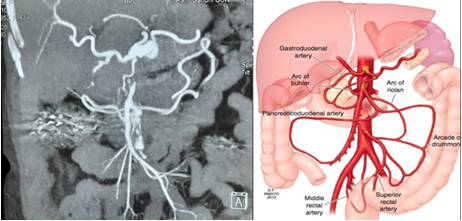 Retrograde Mesenteric Bypass for Chronic Mesenteric Ischaemia(CMI)- A ...