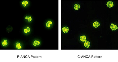 Two Patients with “Acute Kidney Injury” (AKI) and ANCA-Positive State