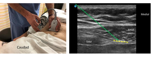 Rectus Sheath Block - A Walking Epidural