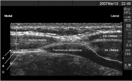 Rectus Sheath Block - A Walking Epidural