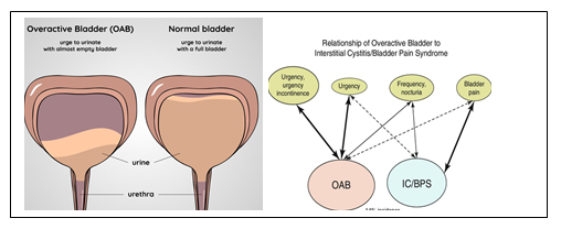 Overactive Bladder (OAB)- Beyond the Basics