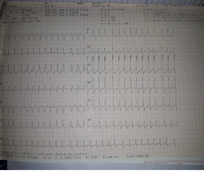 Recurrent Atrial Fibrillation In Pregnancy- Case Report