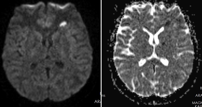 Radiological Evidence in Tuberculous Meningitis