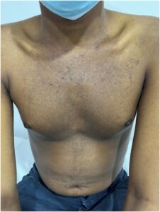 Classic Triad of Dyskeratosis Congenita or Zinsser Cole Engman