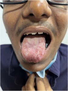 Classic Triad of Dyskeratosis Congenita or Zinsser Cole Engman