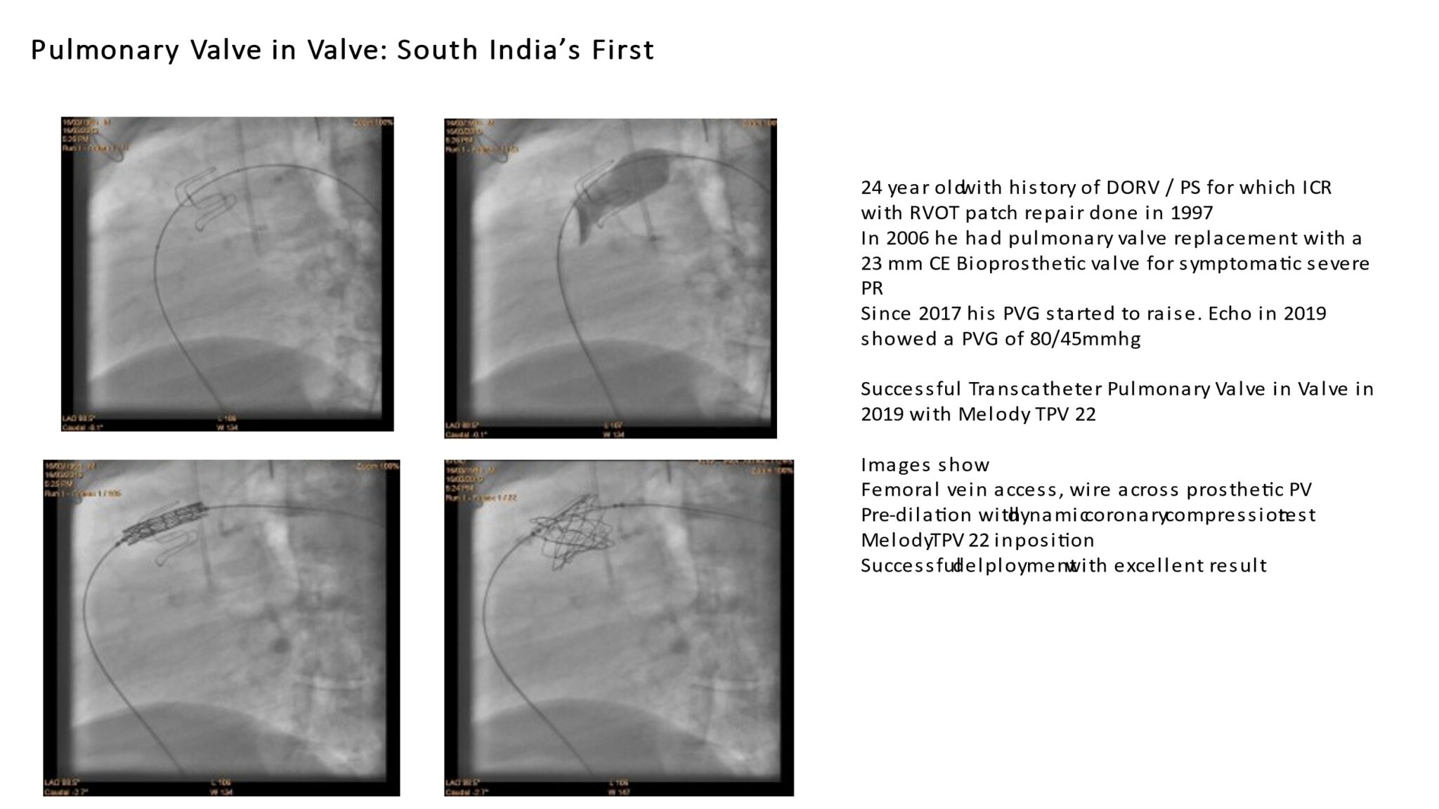 Innovations in Transcatheter Heart Therapy: New Hope for patients