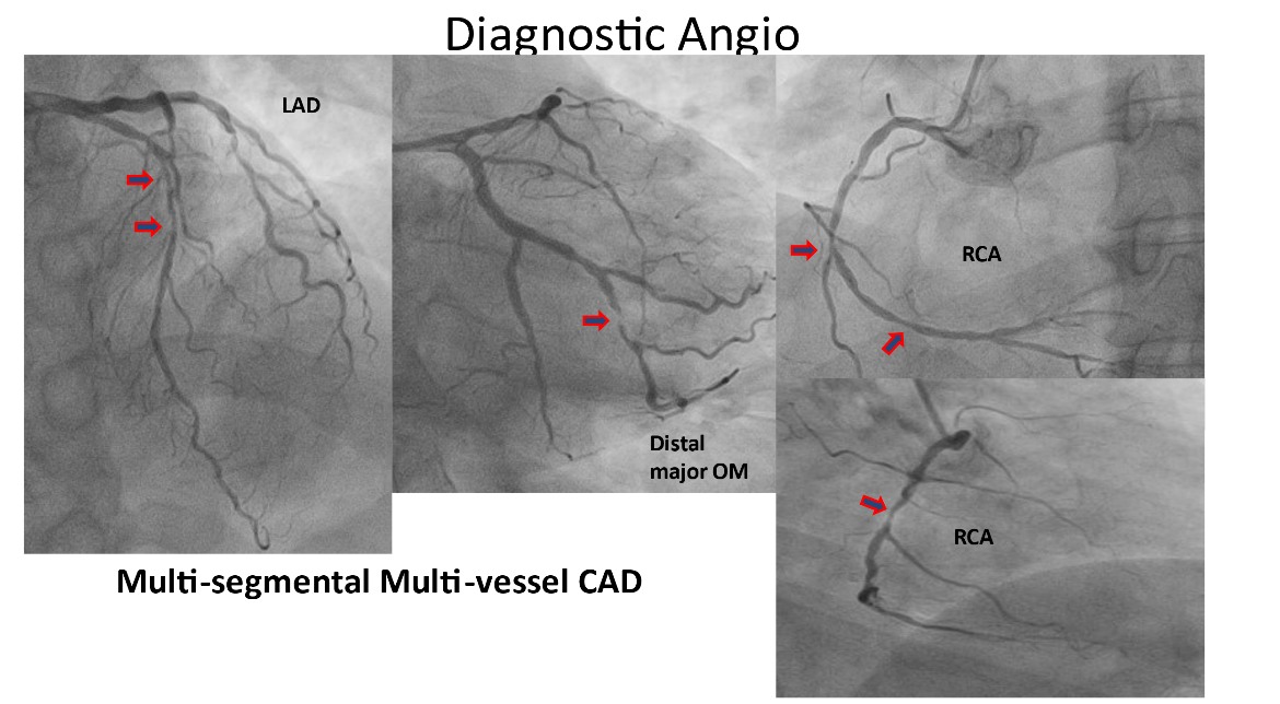 METAL-LESS PCI - new emerging horizon and novel PCI solution for ...