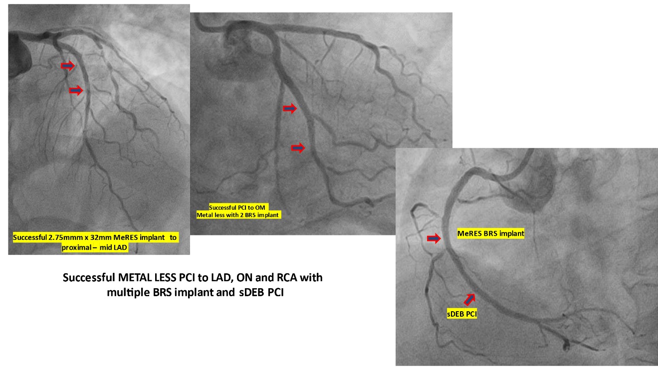 METAL-LESS PCI - new emerging horizon and novel PCI solution for ...