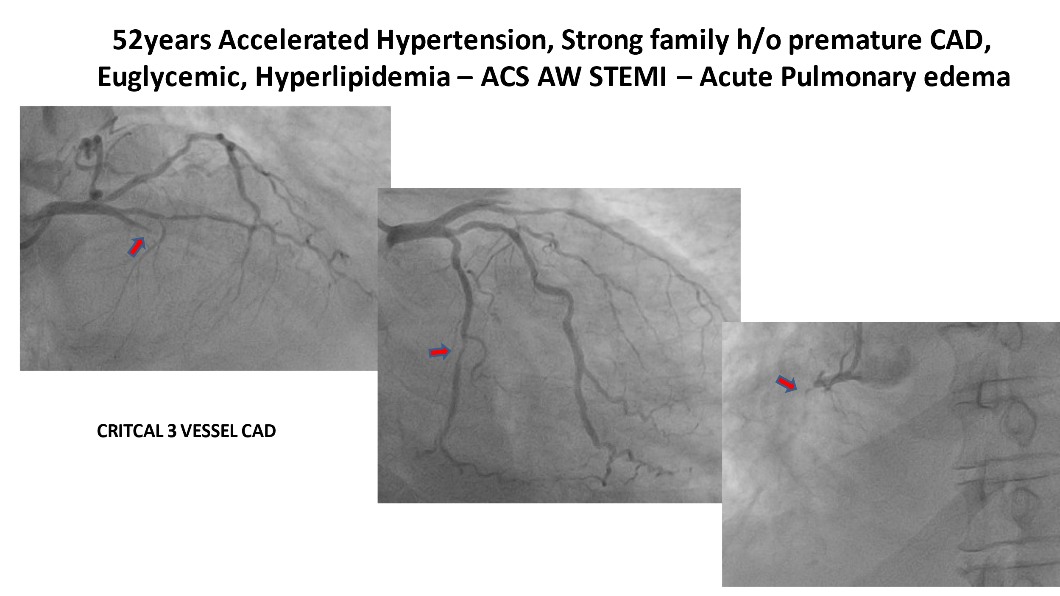 METAL-LESS PCI - new emerging horizon and novel PCI solution for ...