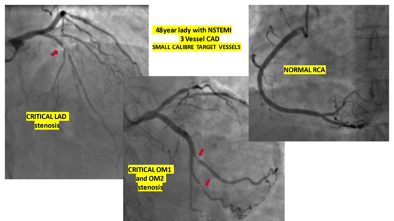 METAL-LESS PCI - new emerging horizon and novel PCI solution for ...