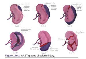 Non Traumatic Splenic Laceration