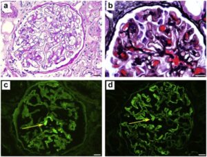 NELL 1 Staining in Primary Membranous Nephropathy – A Case Report