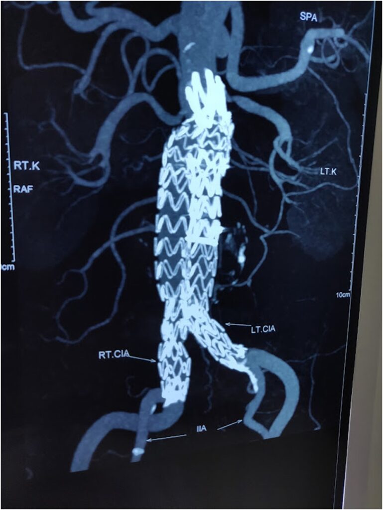 Abdominal Aortic Aneurysm