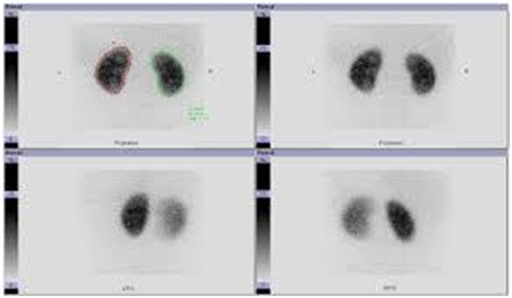 Vesico-ureteric Reflux [VUR] in Children