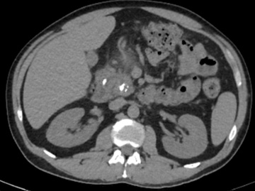 Gastroenterologist With Radiologist Cross-Over - A Rare Encounter