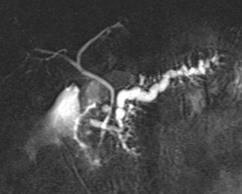 Gastroenterologist With Radiologist Cross-Over - A Rare Encounter