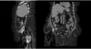 Imaging Modalities For Diagnosis Of Necrotizing Fasciitis: A ...