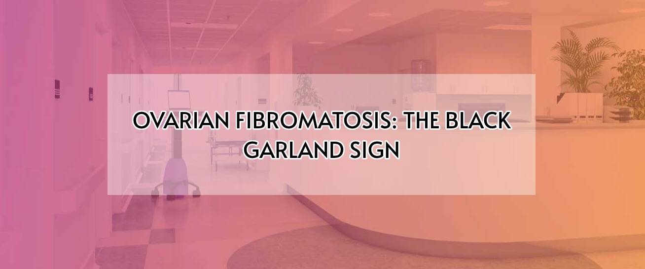 OVARIAN FIBROMATOSIS: THE BLACK GARLAND SIGN