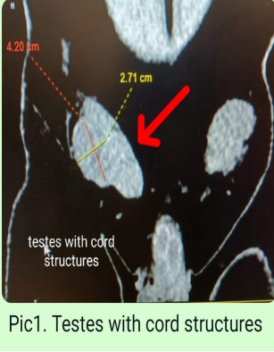 Testicular Dislocation