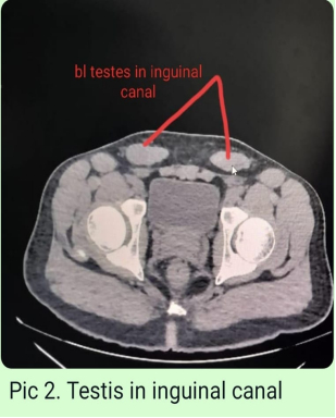Testicular Dislocation