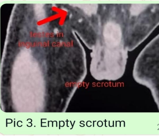 Testicular Dislocation