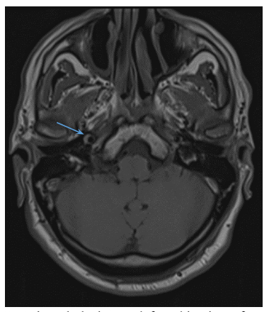 CRESCENT SIGN IN ICA - CLASSICAL CASE OF ICA DISSECTION