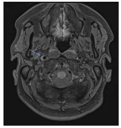CRESCENT SIGN IN ICA - CLASSICAL CASE OF ICA DISSECTION