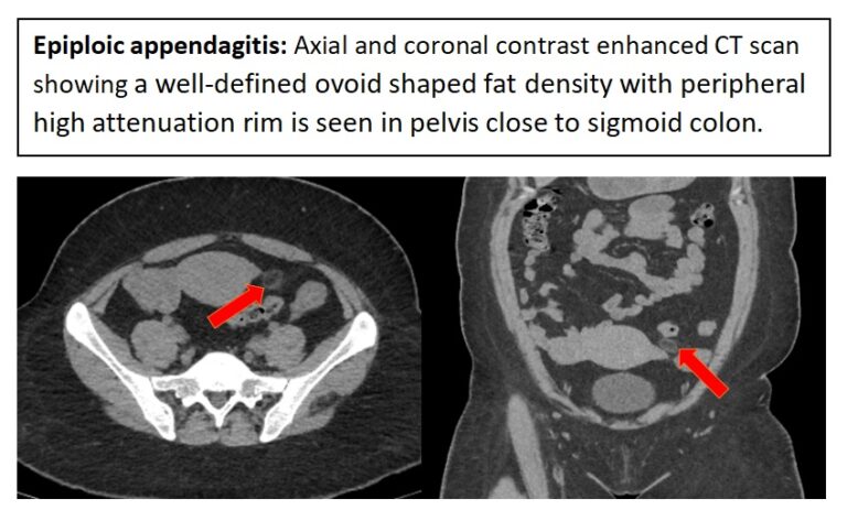 Imaging Spectrum Of Intraperitoneal Focal Fatty Infarction