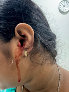 BLOODY SWEAT : A RARE FRIGHTENING CONDITION