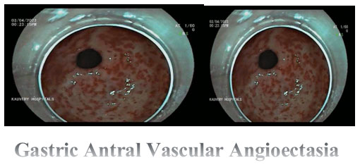 THE ANOMALOUS COMPLICATION OF DENOSUMAB