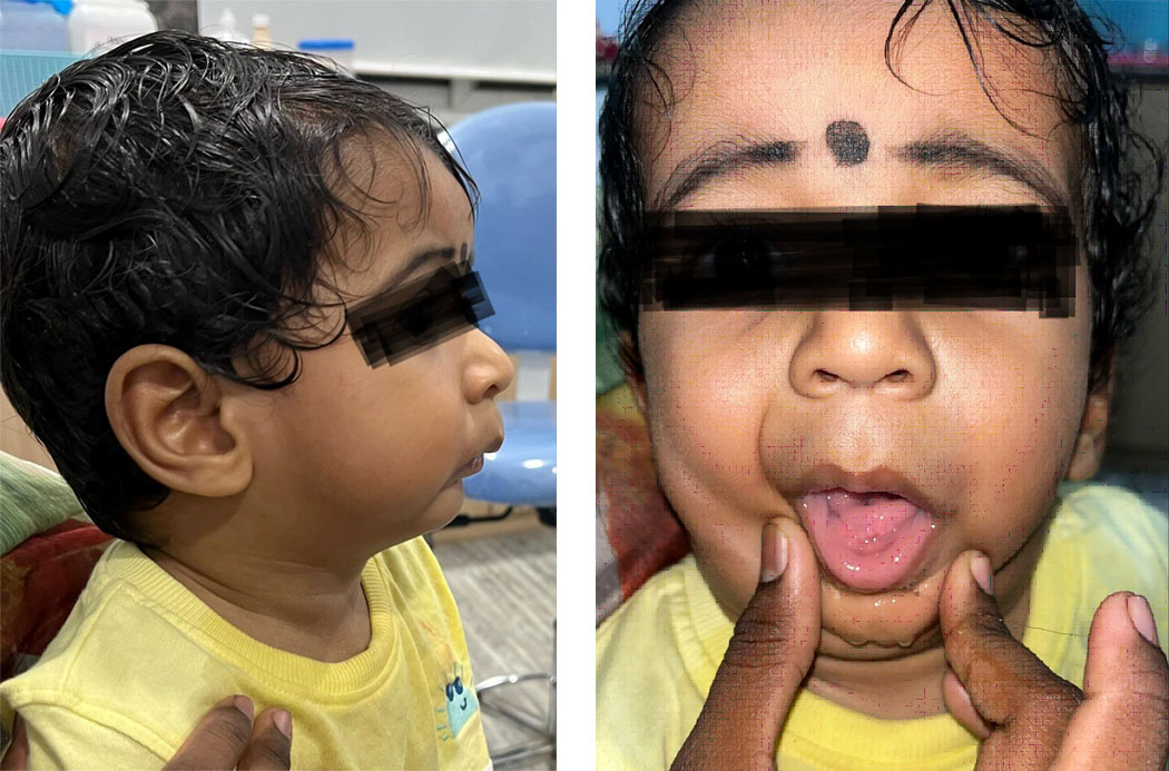 PIERRE ROBIN SEQUENCE (ANAESTHESIA CONSIDERATIONS)