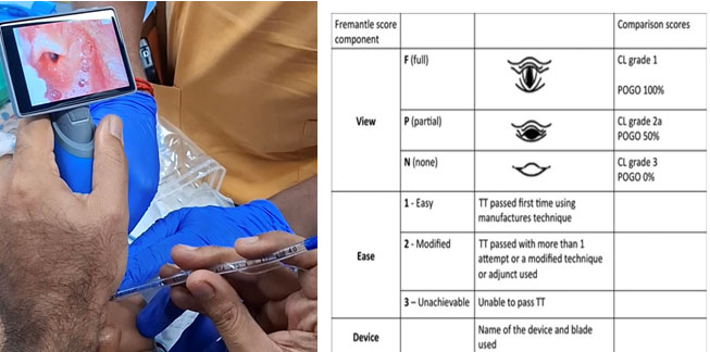 PIERRE ROBIN SEQUENCE (ANAESTHESIA CONSIDERATIONS)