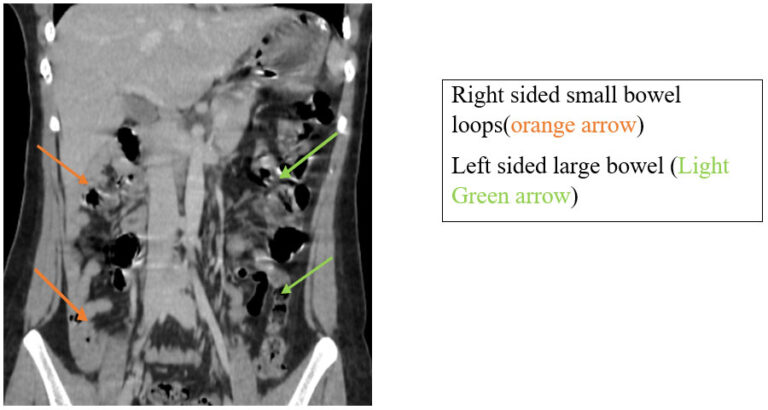Beyond Gastroenteritis: An Unexpected Diagnosis of Intestinal ...