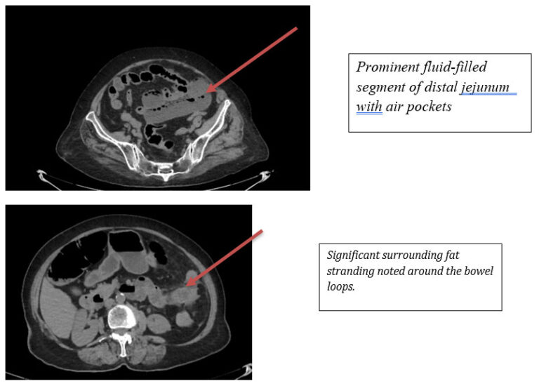 Plain CT clues to early small bowel ischemia: A Miss-Before - You - See ...