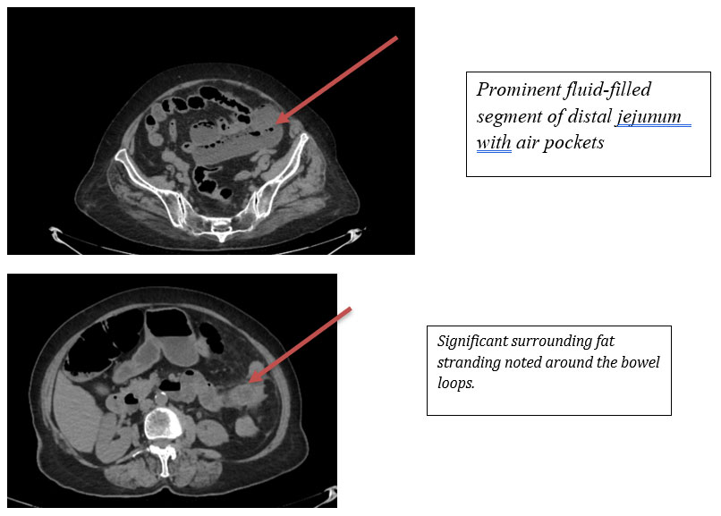 Plain CT clues to early small bowel ischemia: A Miss-Before - You - See ...