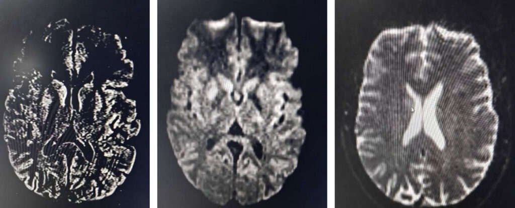 STROKE MASQUERADING AS MOVEMENT DISORDER: ISOLATED HEMICHOREA DUE TO ...