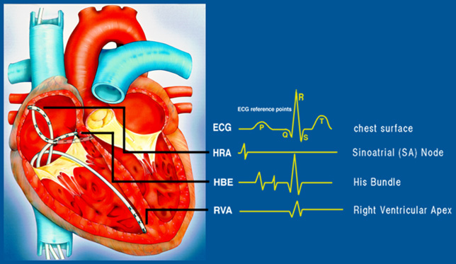 Treatment for Sudden Cardiac Arrest | Electrophysiology | Kauvery ...