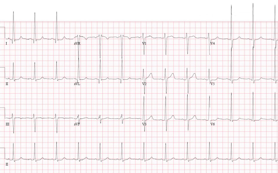 Treatment for Sudden Cardiac Arrest | Electrophysiology | Kauvery ...