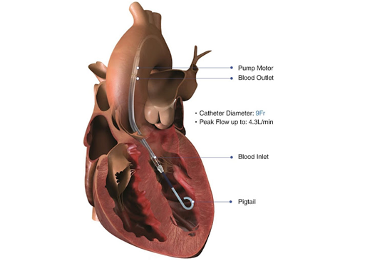 Impella Device | Impella Heart Pump | Kauvery Hospital