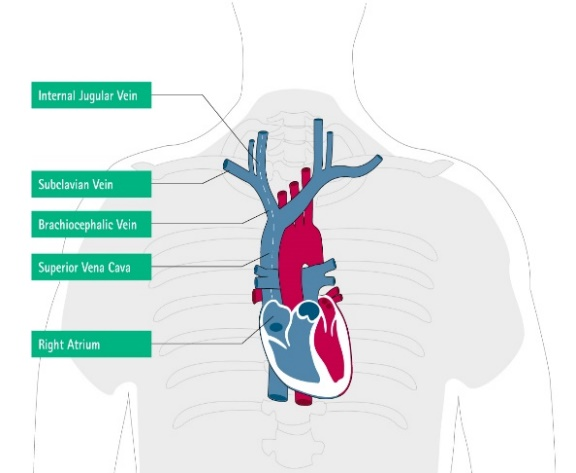 Malposition of central venous catheter: Presentation and management