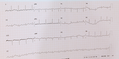 Fever-induced Brugada Syndrome - Kauvery Hospital