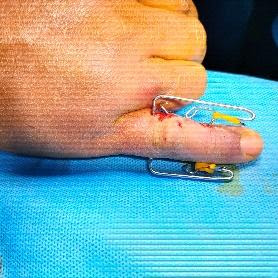 Dynamic external fixator for unstable intra articular fractures of ...