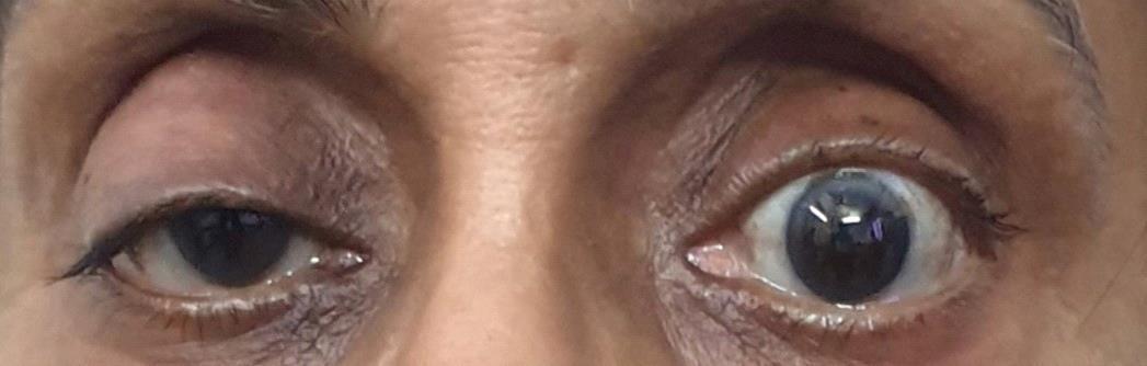 “Icing” The Eyes - Kauvery Hospital