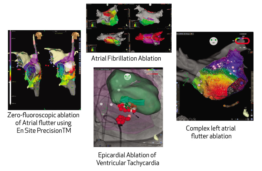 Cardiac Electrophysiology | Best Cardiac Electrophysiologist | Kauvery ...