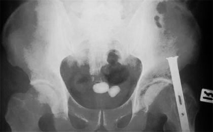 UNDERSTANDING BLADDER STONES - Kauvery Hospital