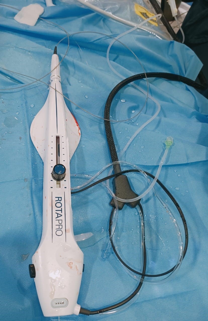 IVUS-Guided PTCA Success: Case Study | Kauvery Hospital