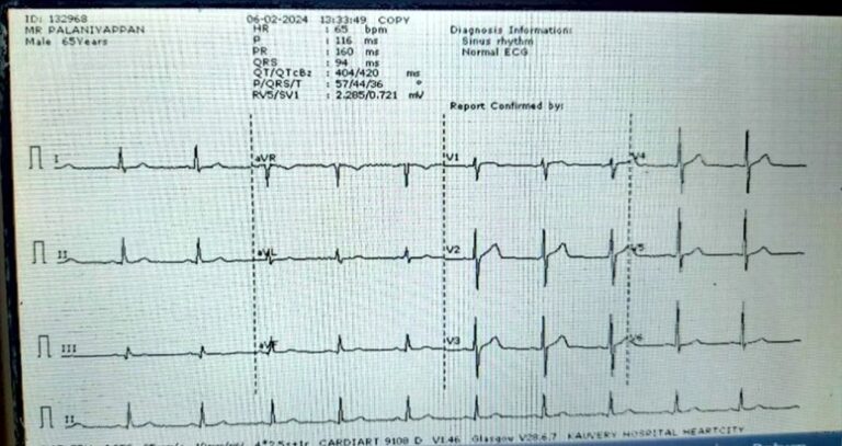 ST Elevation on TMT Without Prior MI: Double Vessel Disease & PTCA Case ...