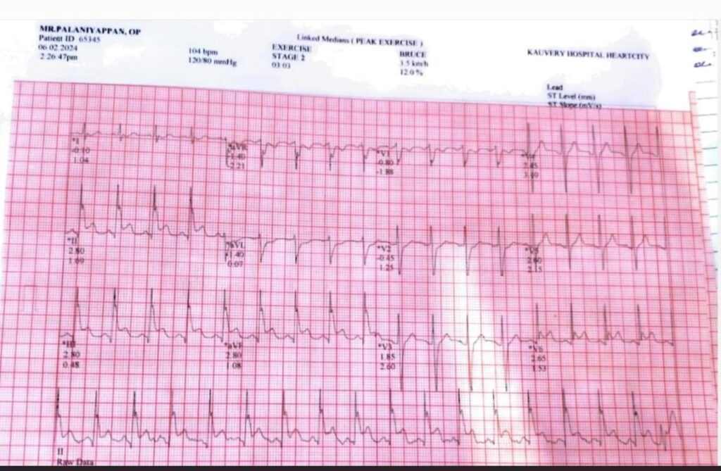 ST Elevation on TMT Without Prior MI: Double Vessel Disease & PTCA Case ...